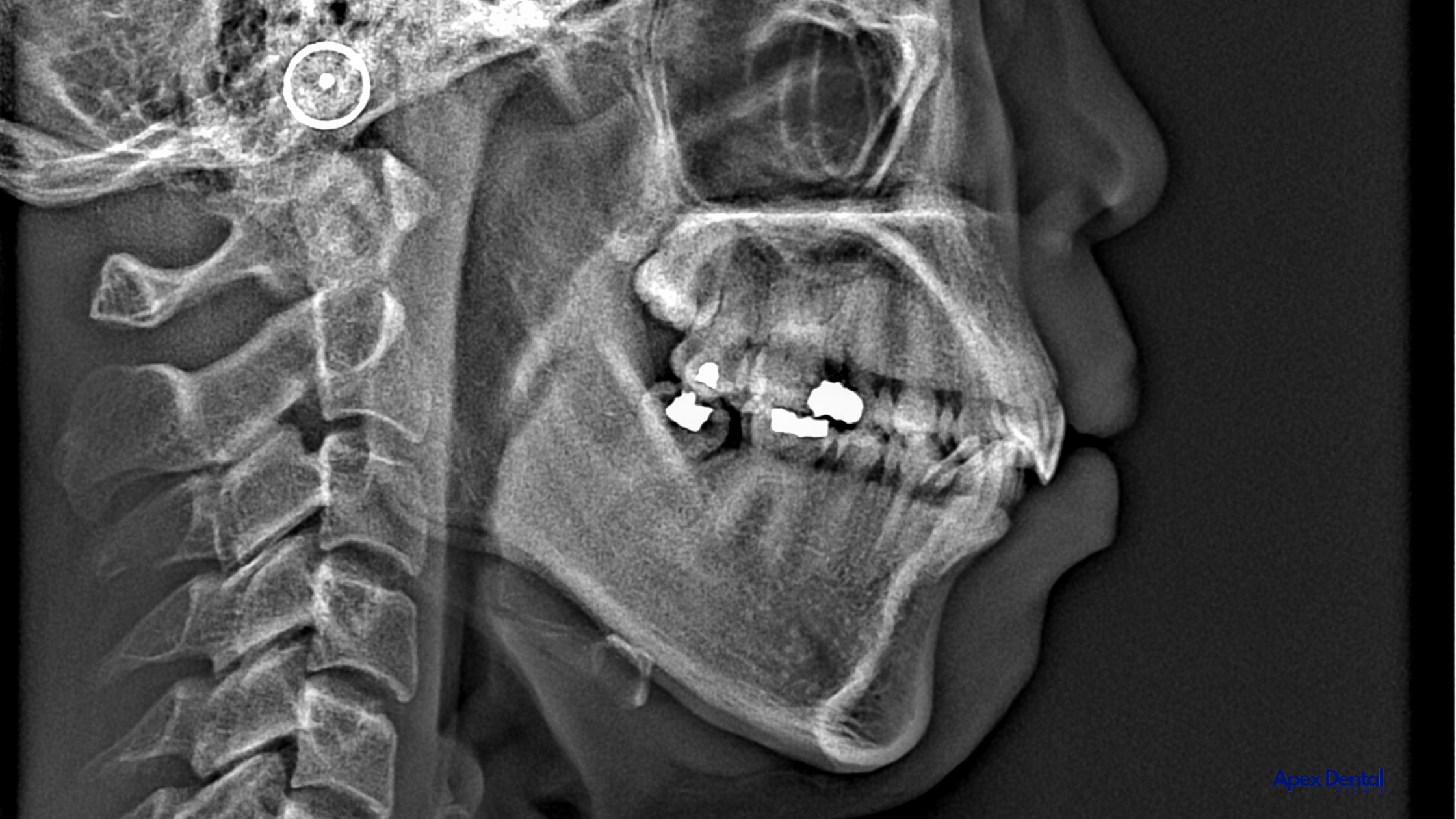 Airway-Centered Orthodontics: Utilizing CBCT and Sleep Studies for Ear ...